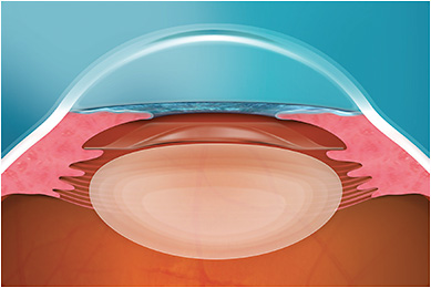 A new lens on myopia correction | Ophthalmic Professional