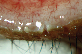 Ophthalmic Professional | PentaVision